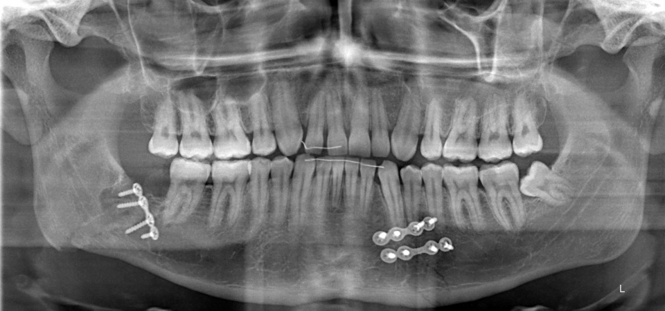 Jaw Fractures | Srikanth Dental | Godavarikhani
